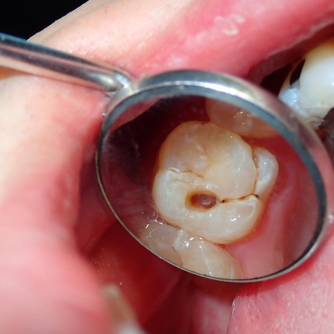 Can Tiny Cavities Heal By Themselves? - Dr. Suzanne Land & Associates ...